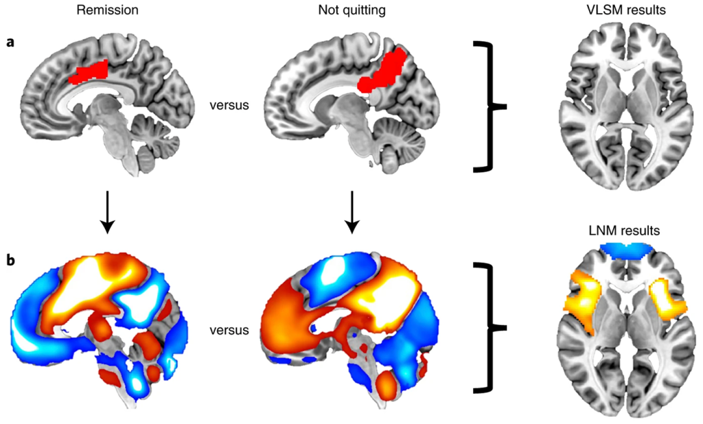 Brain lesions disrupting addiction map to a common human brain circuit.